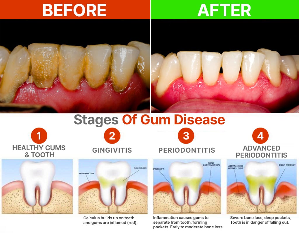 5 Best Plaque Removers 2024 – 5 Best Compared